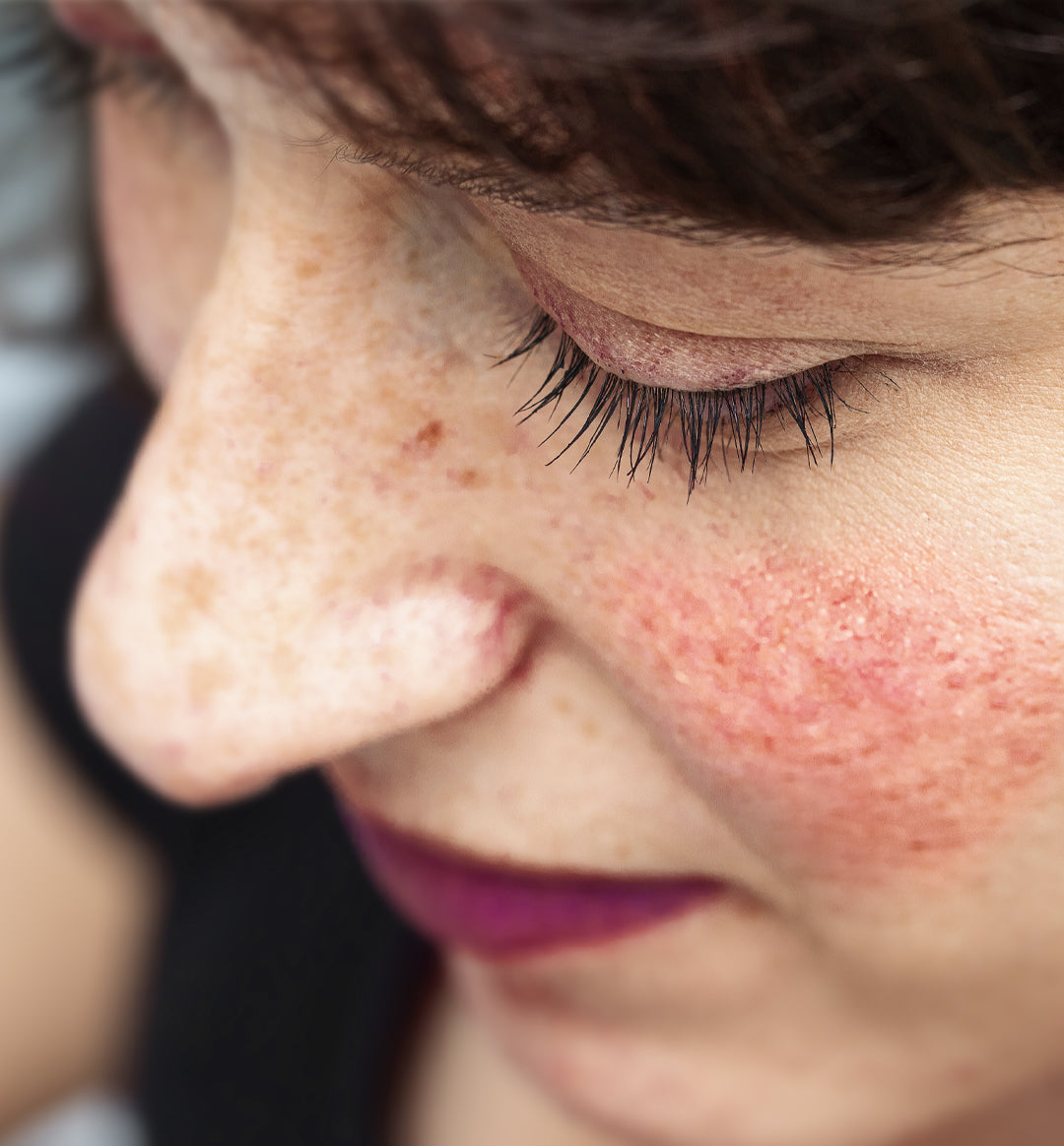 Blotchy Skin or Rosacea – What’s the Difference? | 100% PURE