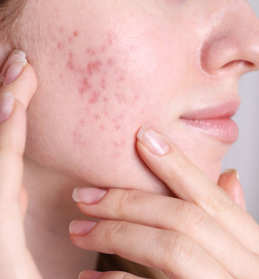 Acne Scars Be Gone: 7 Natural Solutions for Flawless Skin – 100% PURE