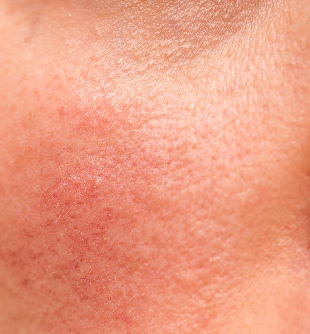 5 Tips To Improve Your Uneven Skin Texture – 100% PURE